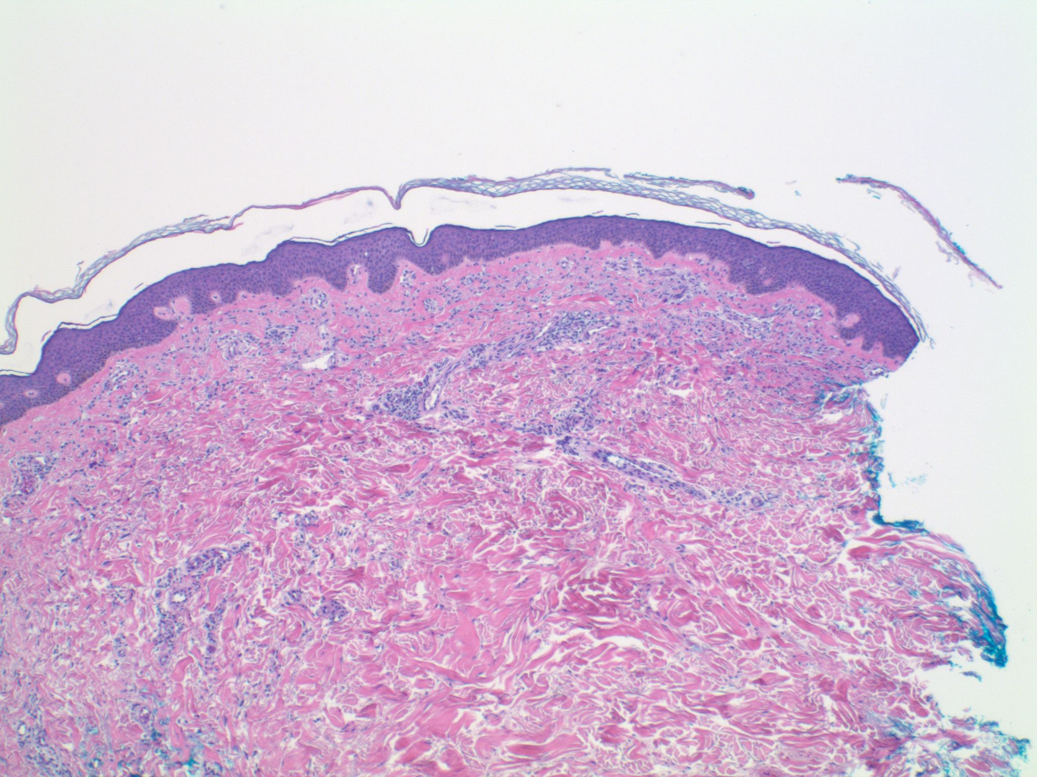 Generalized Rash textbook Case Of This Entity UPDATED WITH IMAGES generalized-rash-textbook-case-of-this-entity-updated-with-images