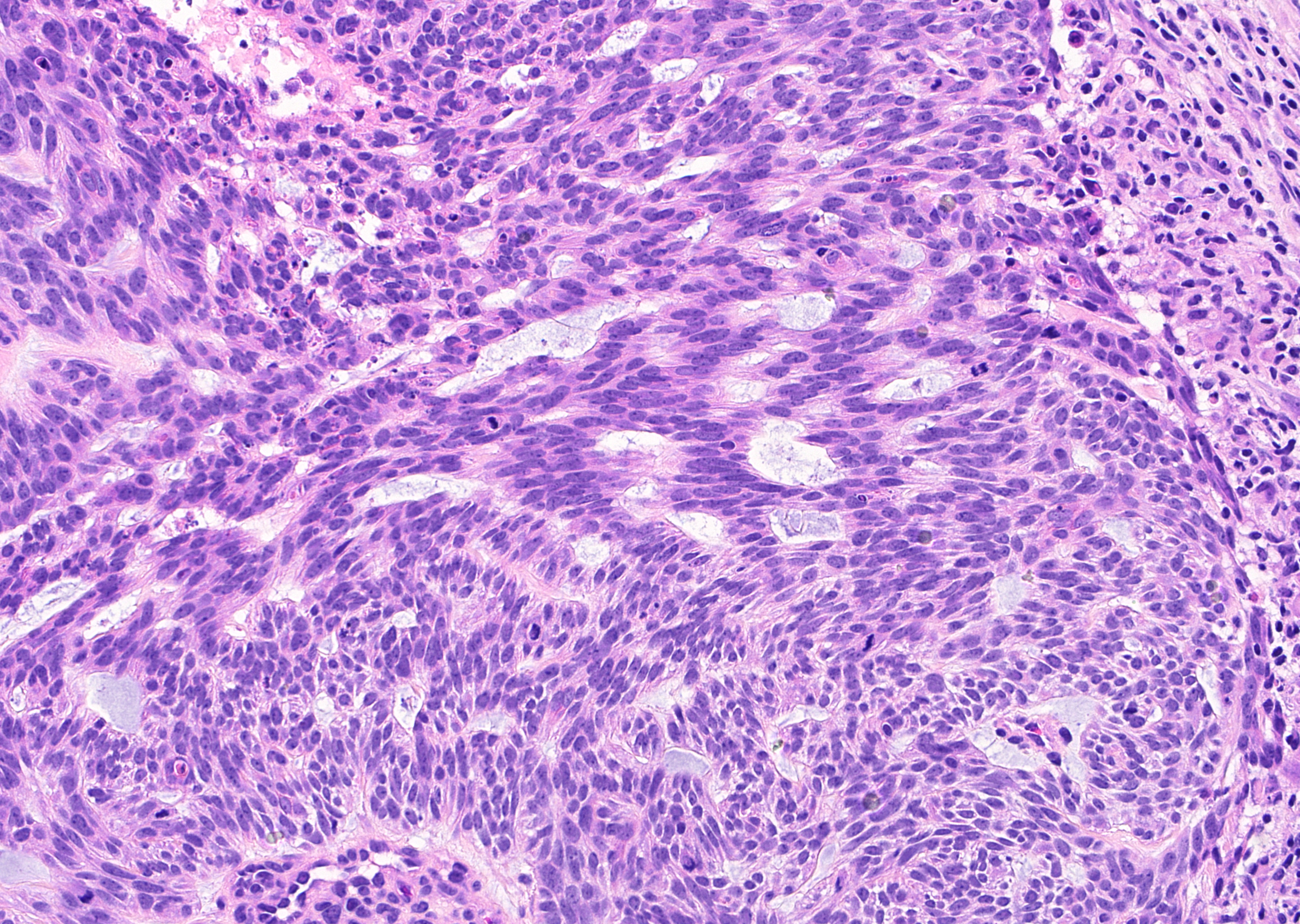Basal Cell Carcinoma Histology Palisading