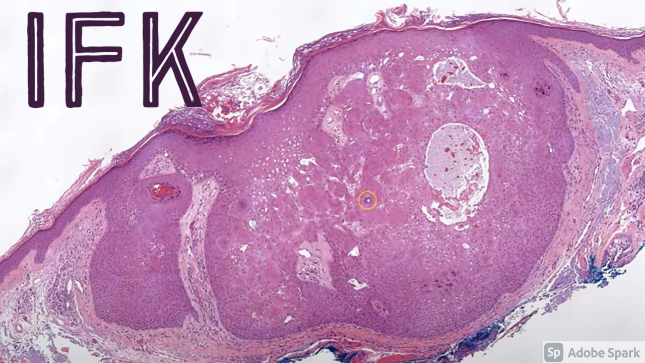 Irritated Seborrheic Keratosis Histology