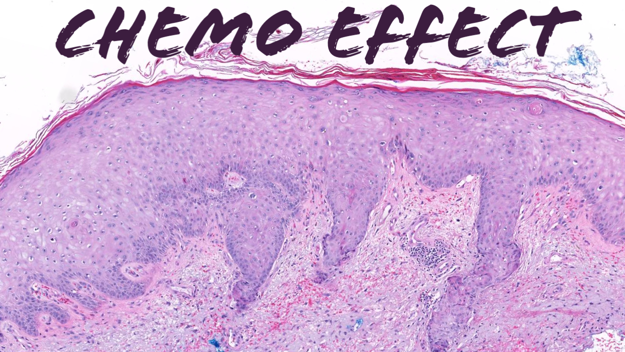 Itchy Rash After Chemotherapy at Jordan Judah blog