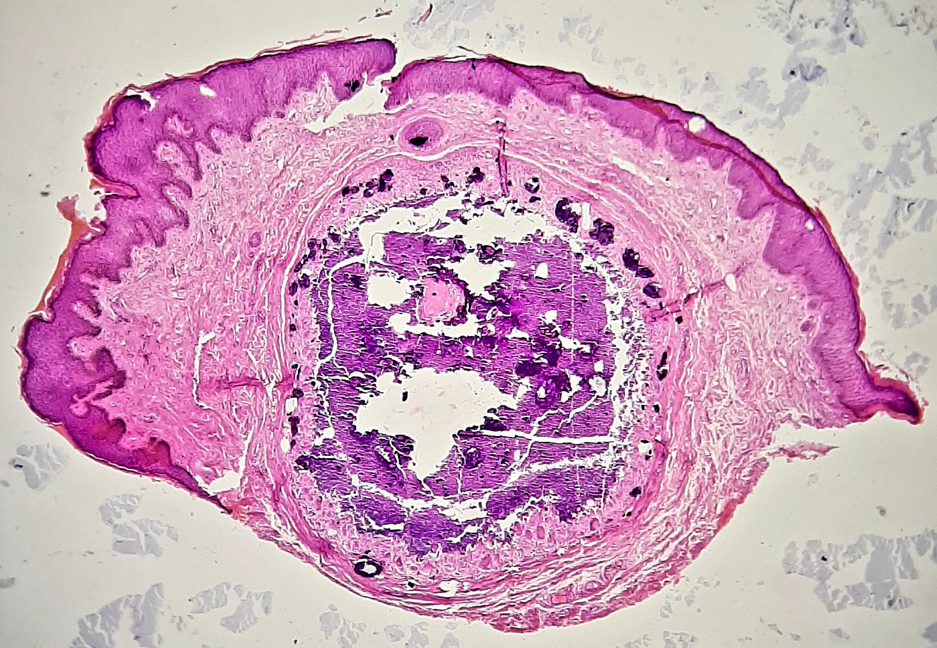 Idiopathic Calcinosis Cutis Of The Scrotum Kiko Xp