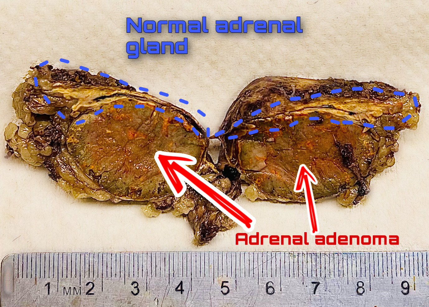 Adrenal Gland Gross Anatomy