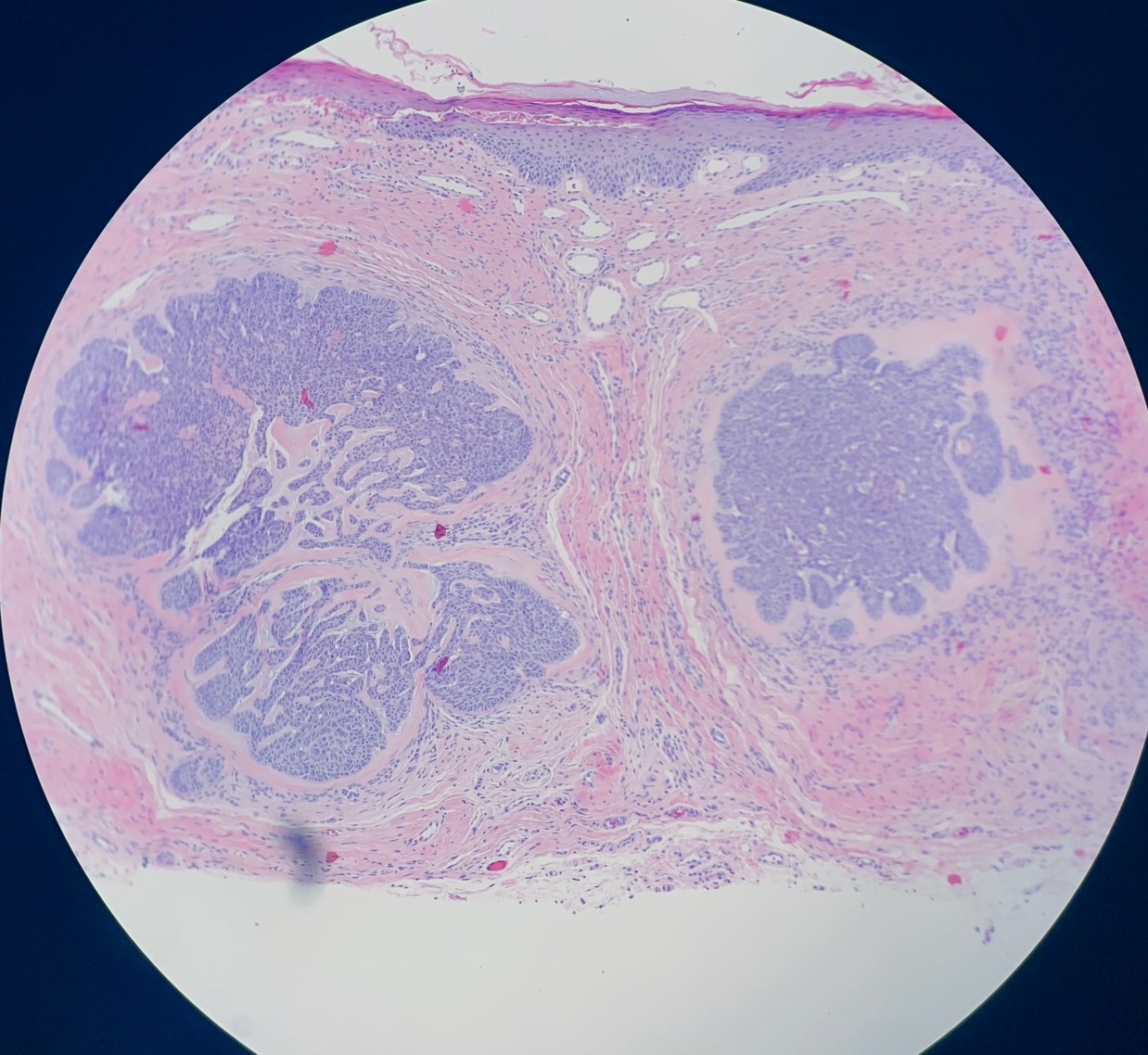 Now Help Me Classify This Lesion😀 Kiko Xp