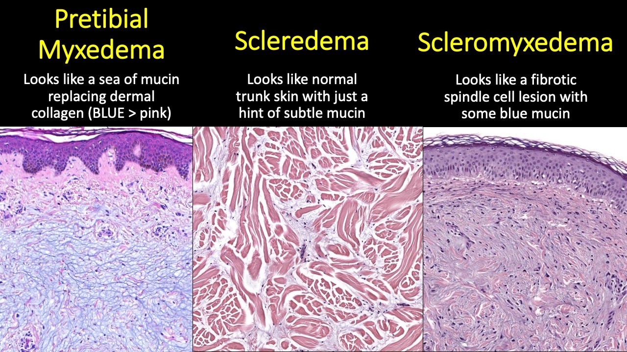 Pretibial Myxedema Vs Scleredema Vs Scleromyxedema Easy Way To Distinguish These Dermpath