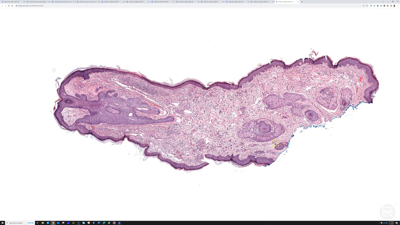 Fibrous Papule Histology