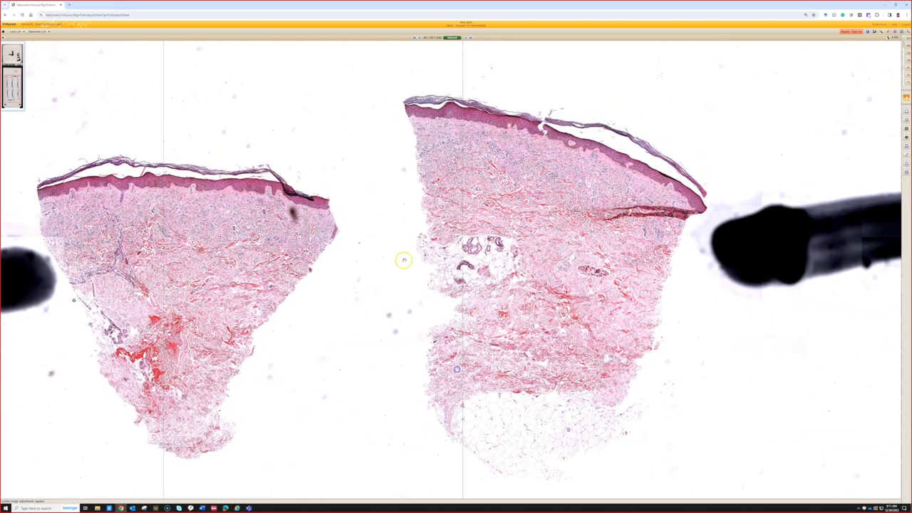 Scleromyxedema Pathology