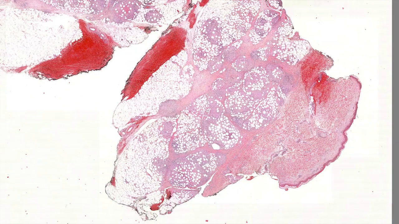 Erythema Induratum Pathology Dermatopathology Evaluation Of