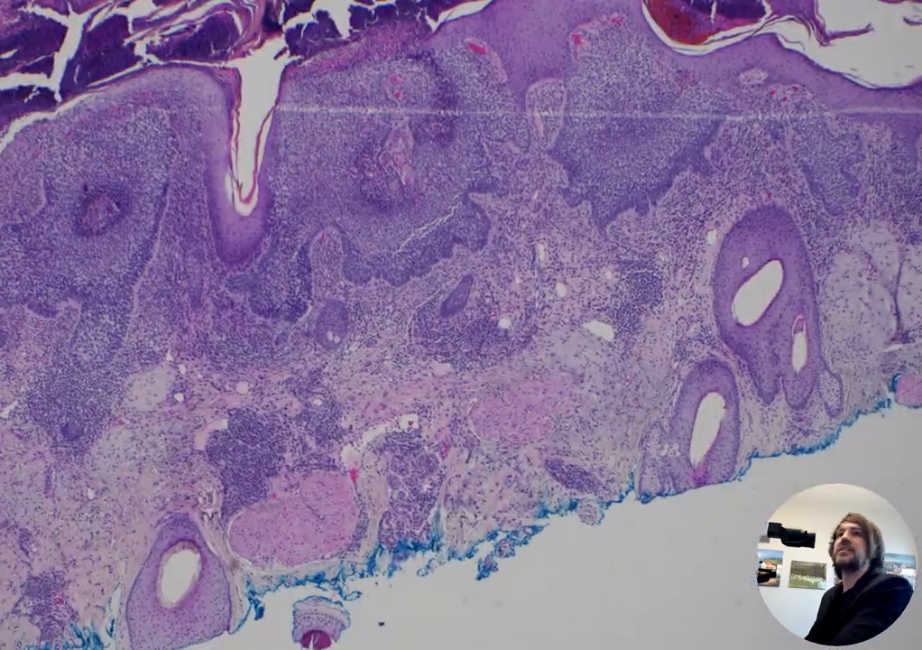 Plasma Cells Skin Histology