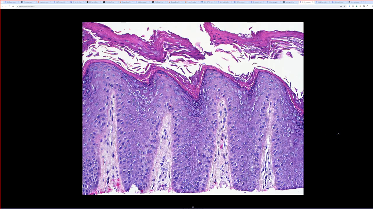 Verruca Plana Histology